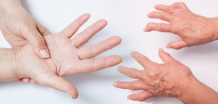 Herbal Medicines for Rheumatoid Arthritis